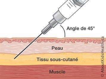 La voie d’abord périphérique sous-cutanée (VSC) - Perfusion à domicile