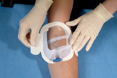 Cathéters périphériques, Cathlon, Midline - Perfusion à domicile